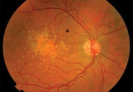 Retinal Conditions – Westfield Eye Center